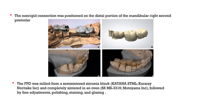 Monolithic zirconia crown with rigid and non rigid connectors | PPTX ...