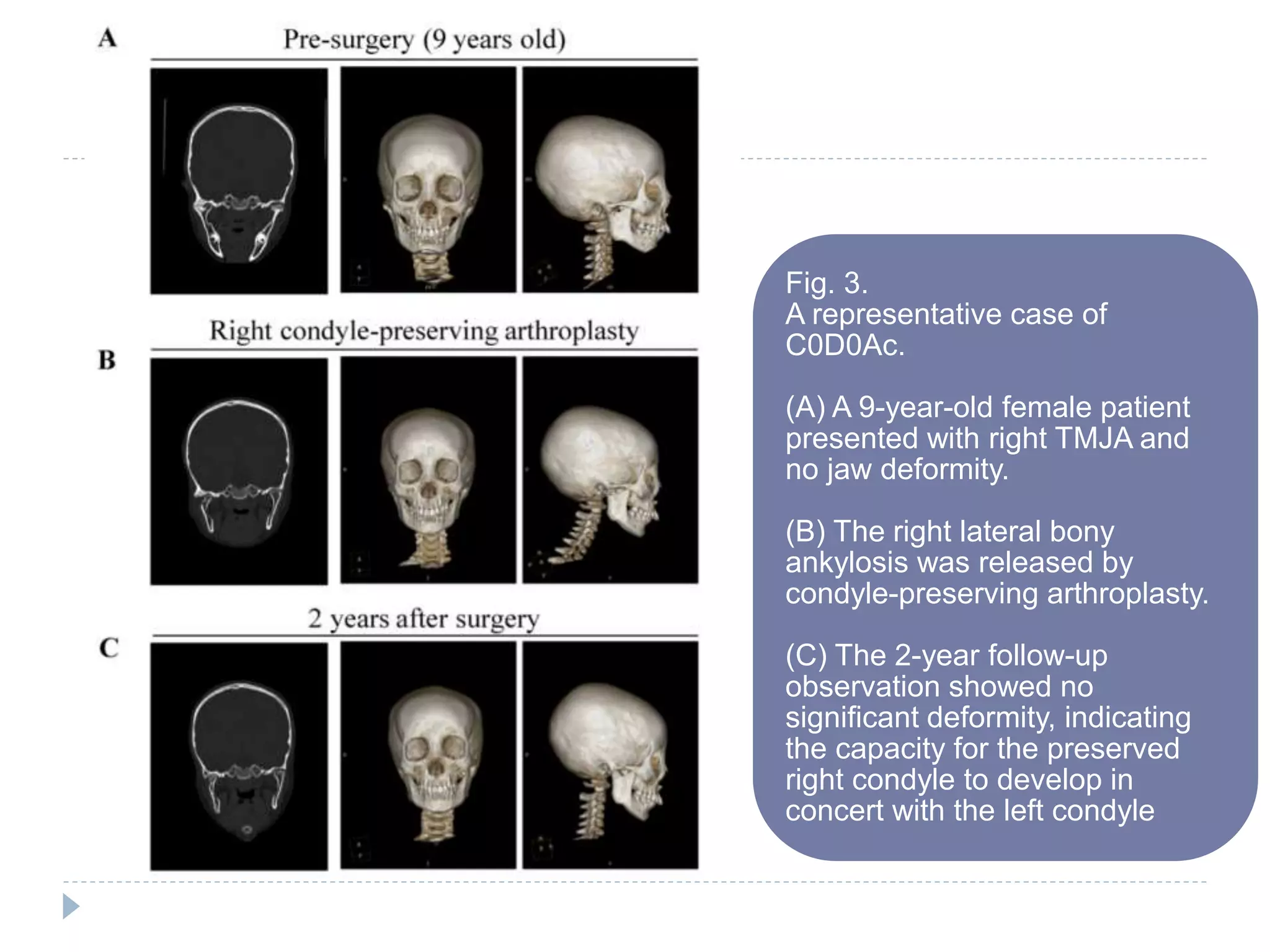 New Clinical Classification & Treatment Strategies For TMJ Ankylosis | PPTX