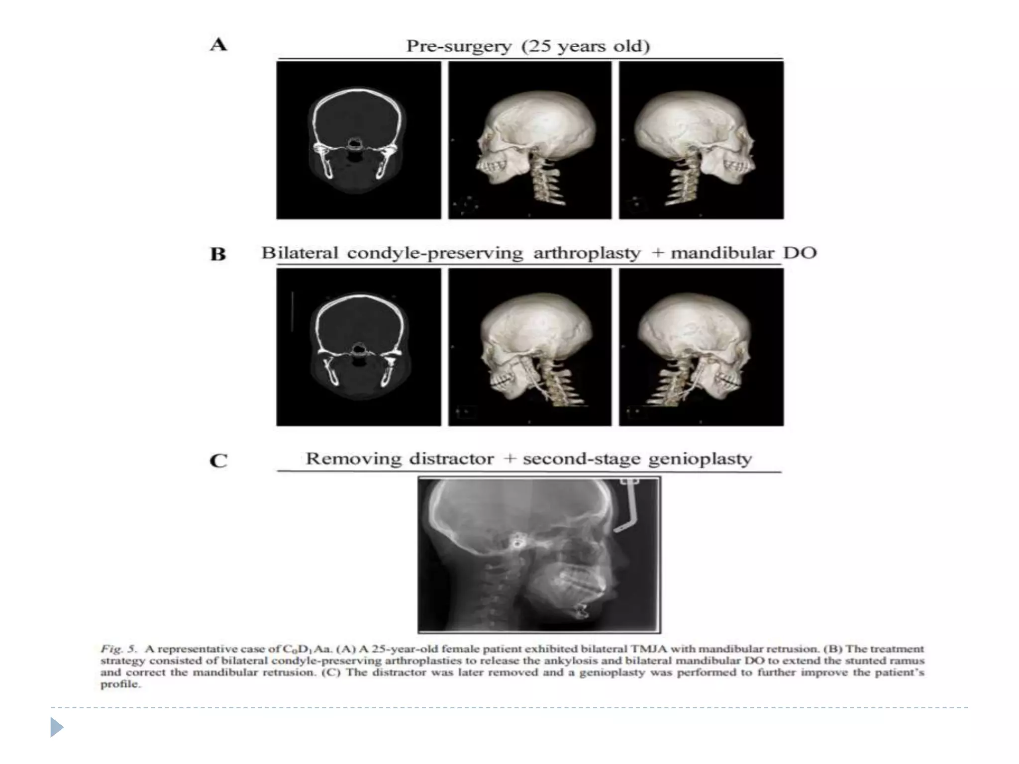 New Clinical Classification & Treatment Strategies For TMJ Ankylosis | PPTX