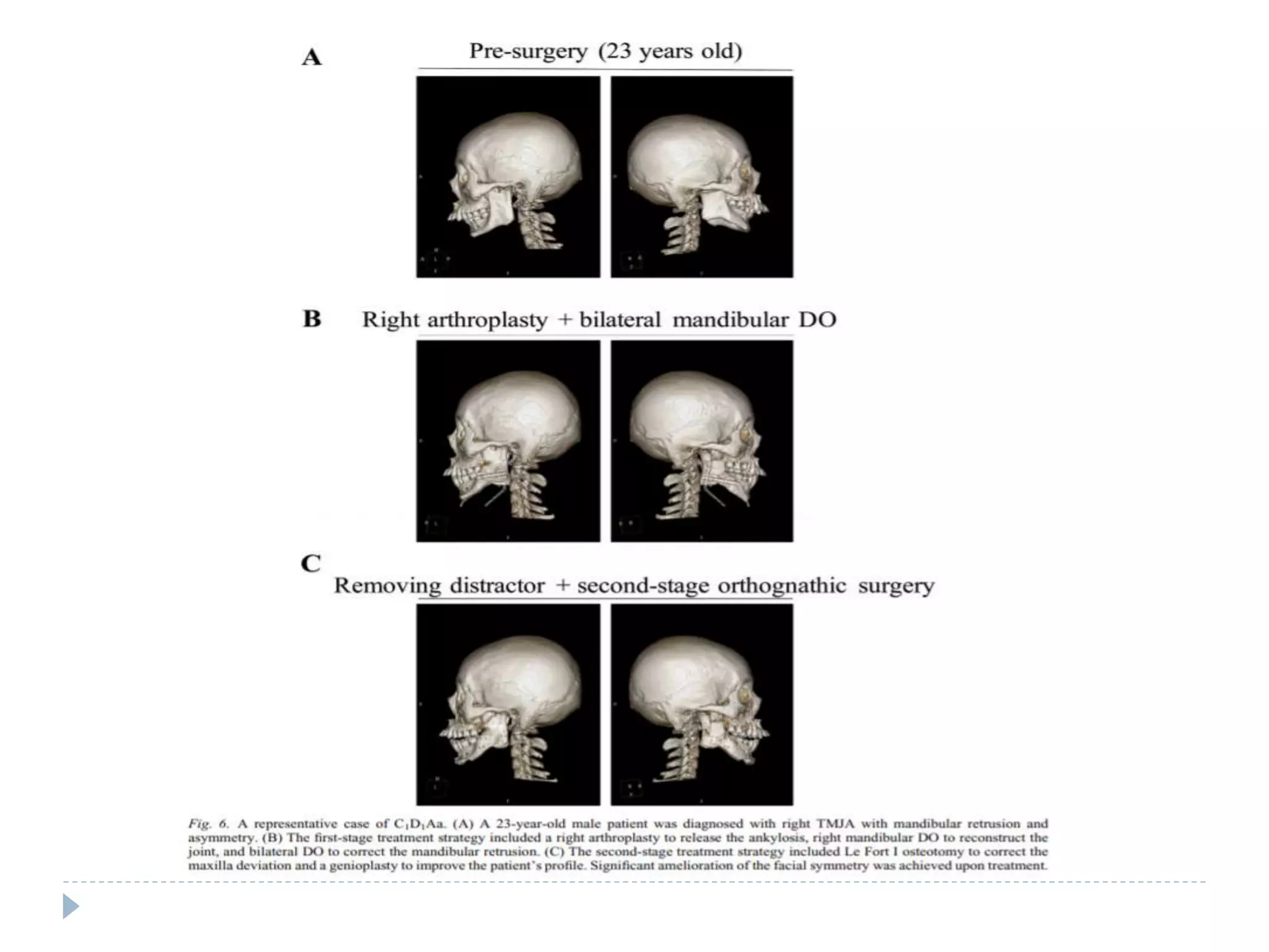 New Clinical Classification & Treatment Strategies For TMJ Ankylosis | PPTX