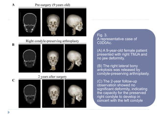 New Clinical Classification & Treatment Strategies For TMJ Ankylosis | PPTX