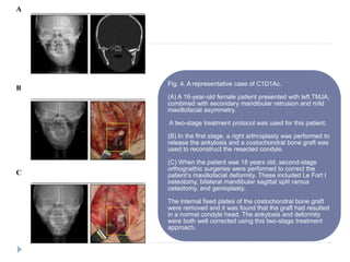 New Clinical Classification & Treatment Strategies For TMJ Ankylosis | PPTX