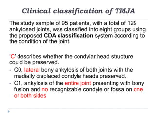 New Clinical Classification & Treatment Strategies For TMJ Ankylosis | PPTX