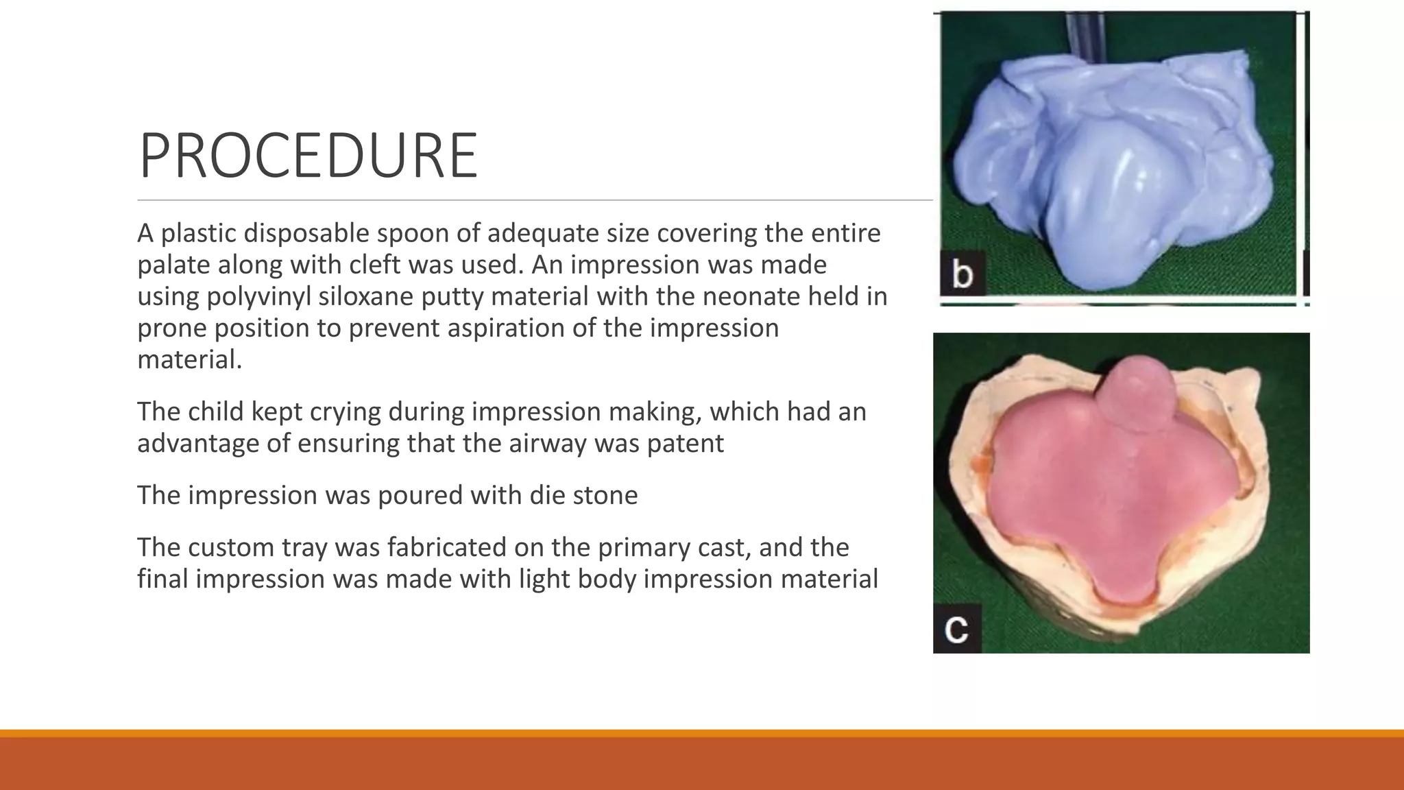 JOURNAL CLUB PRESENTATION IN PROSTHODONTICS ON FEEDING APPLIANCES USED ...