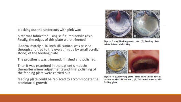 JOURNAL CLUB PRESENTATION IN PROSTHODONTICS ON FEEDING APPLIANCES USED ...