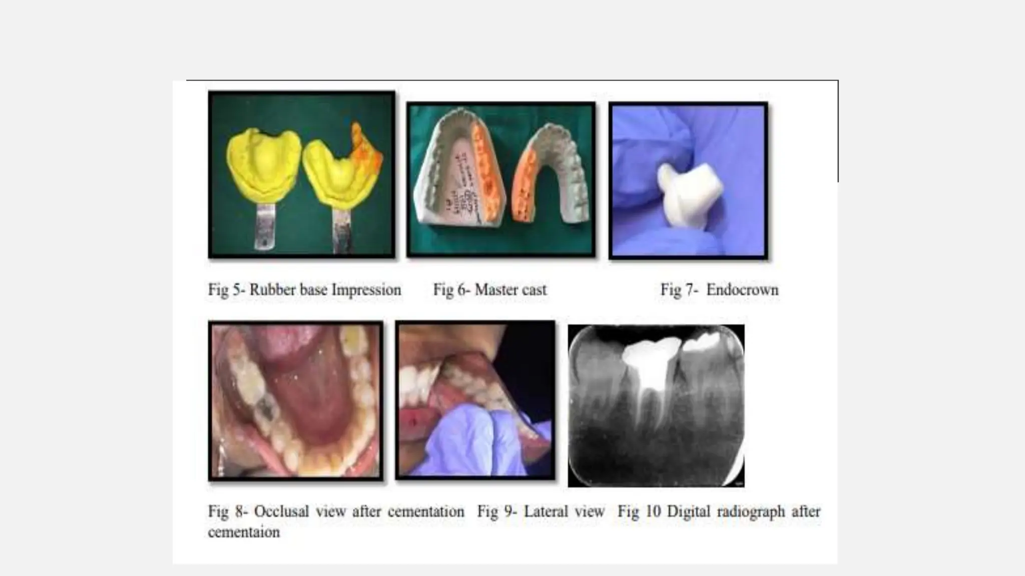 ENDOCROWNS AN INNOVATIVE APPROACH, INDICATION AND ADVANTAGES ...