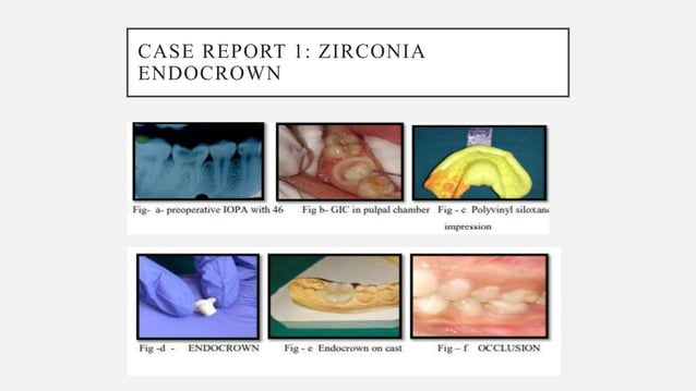 ENDOCROWNS AN INNOVATIVE APPROACH, INDICATION AND ADVANTAGES ...