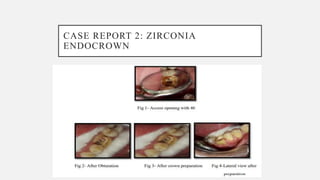 ENDOCROWNS AN INNOVATIVE APPROACH, INDICATION AND ADVANTAGES ...