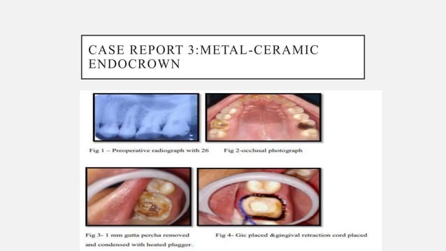 ENDOCROWNS AN INNOVATIVE APPROACH, INDICATION AND ADVANTAGES ...