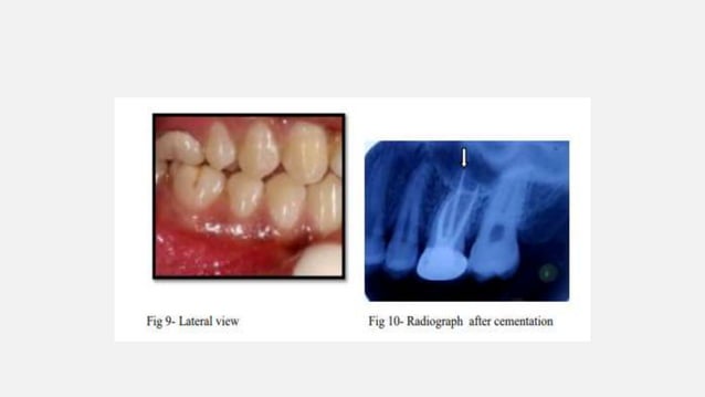 ENDOCROWNS AN INNOVATIVE APPROACH, INDICATION AND ADVANTAGES ...