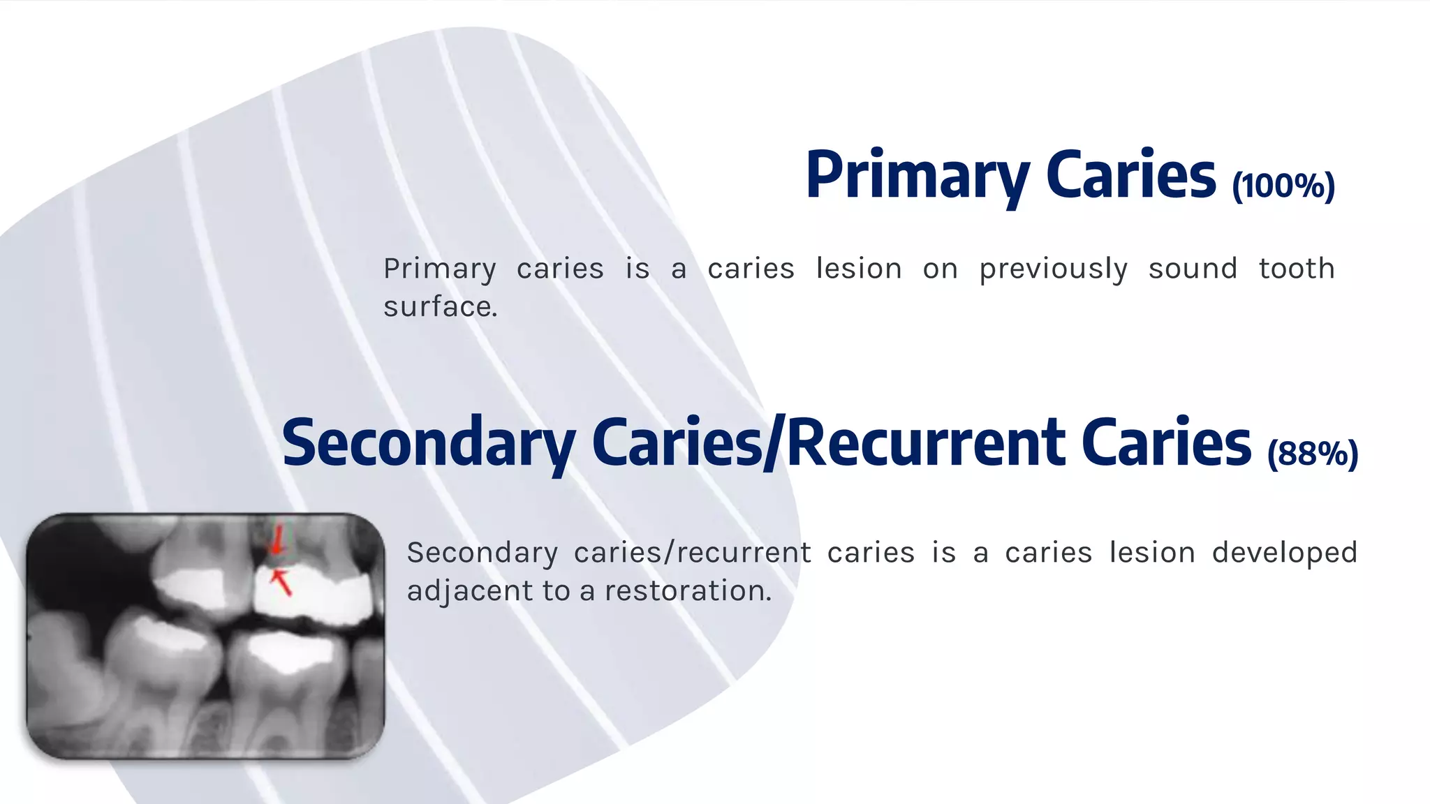 JOURNAL CLUB: Terminology of Dental Caries and Dental Caries Management ...