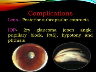 jCA-uveitis 2 [Autosaved].pptx