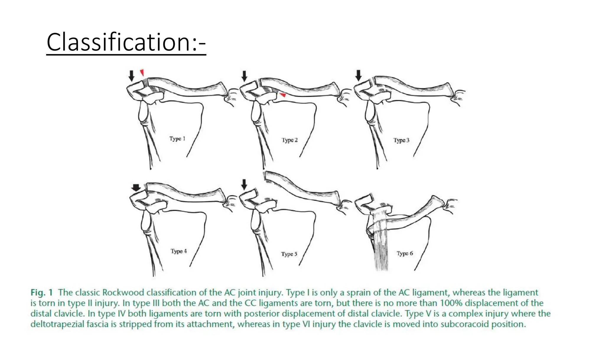 JC Acromioclavicular joint injuries.pptx
