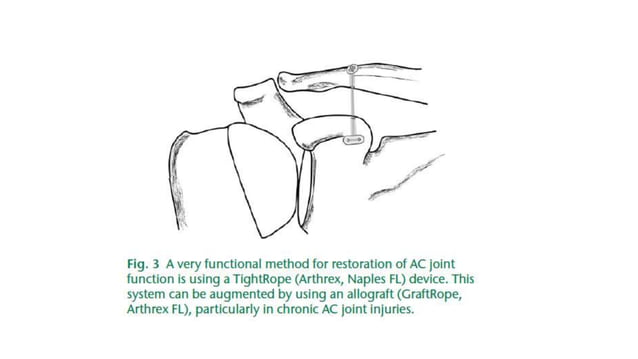 JC Acromioclavicular joint injuries.pptx