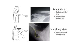 JC Acromioclavicular joint injuries.pptx