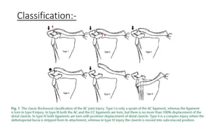 JC Acromioclavicular joint injuries.pptx