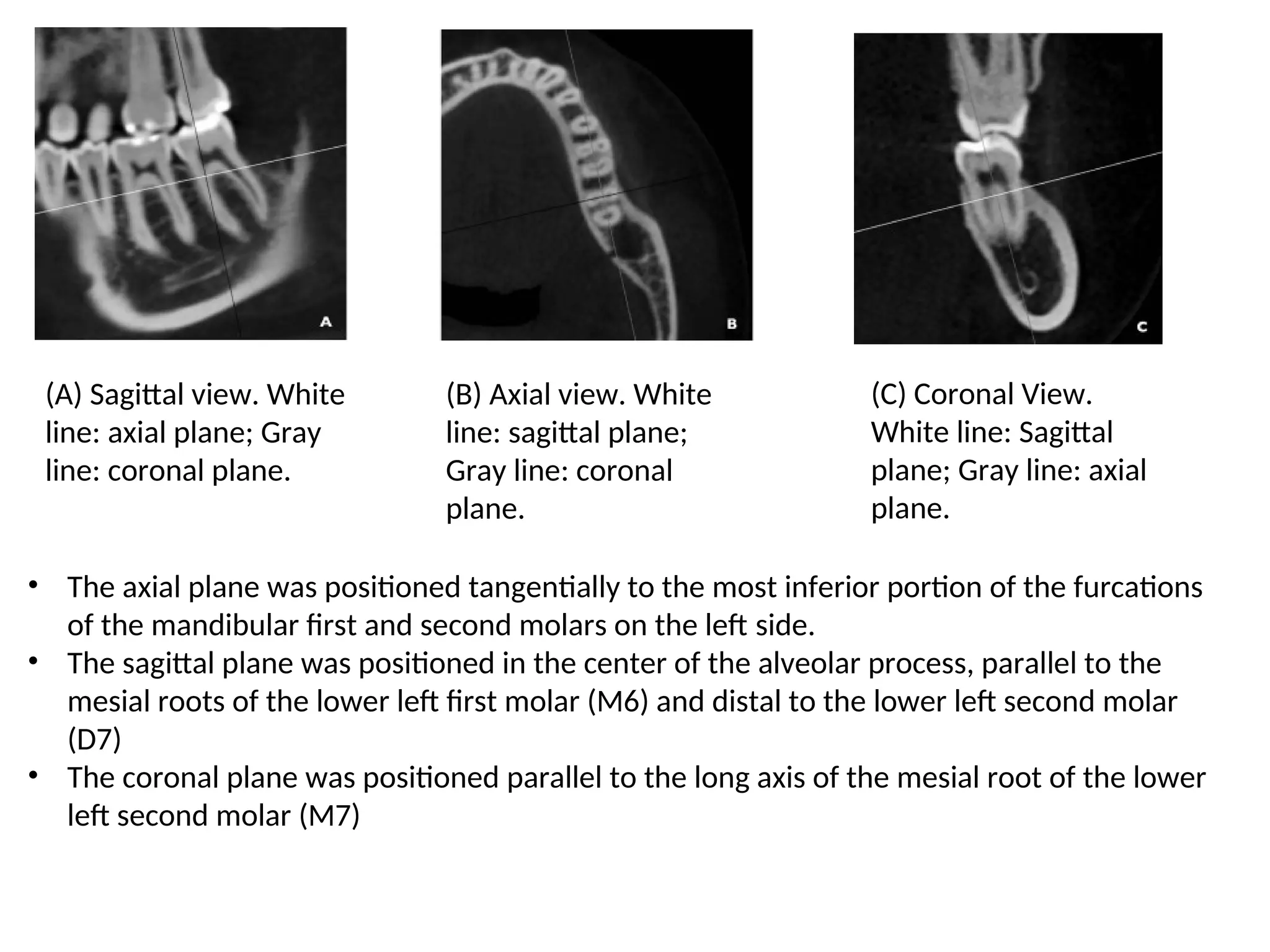 JC Bone thickness and height of the buccal shelf area and the ...