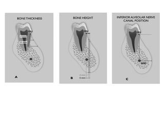 JC Bone thickness and height of the buccal shelf area and the ...