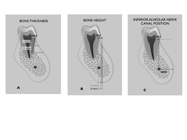 JC Bone thickness and height of the buccal shelf area and the ...