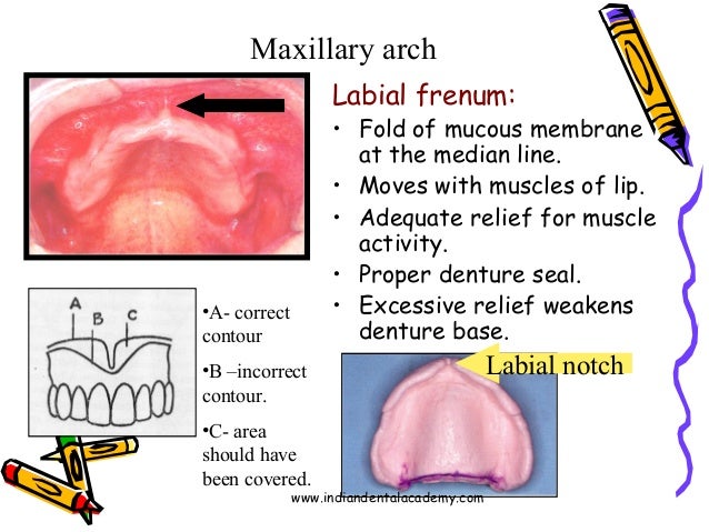 Maxillary Landmarks Labial Frenum Incisive Papilla COMMSD 5433 Study