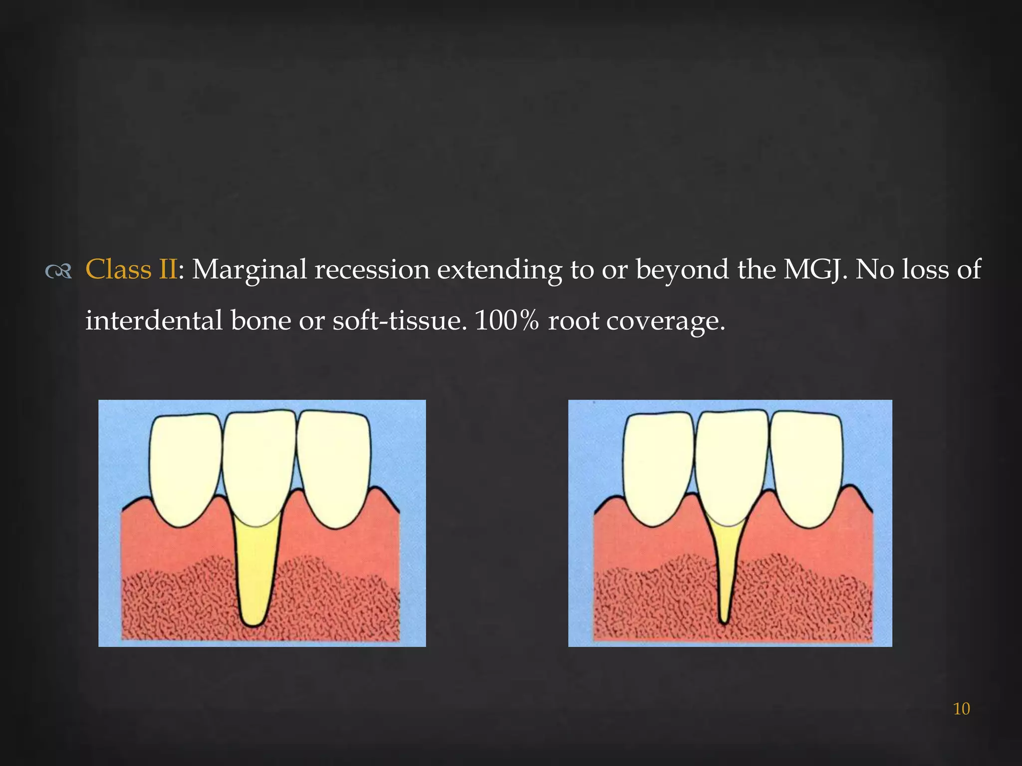 Gingival recession classifications | PPTX