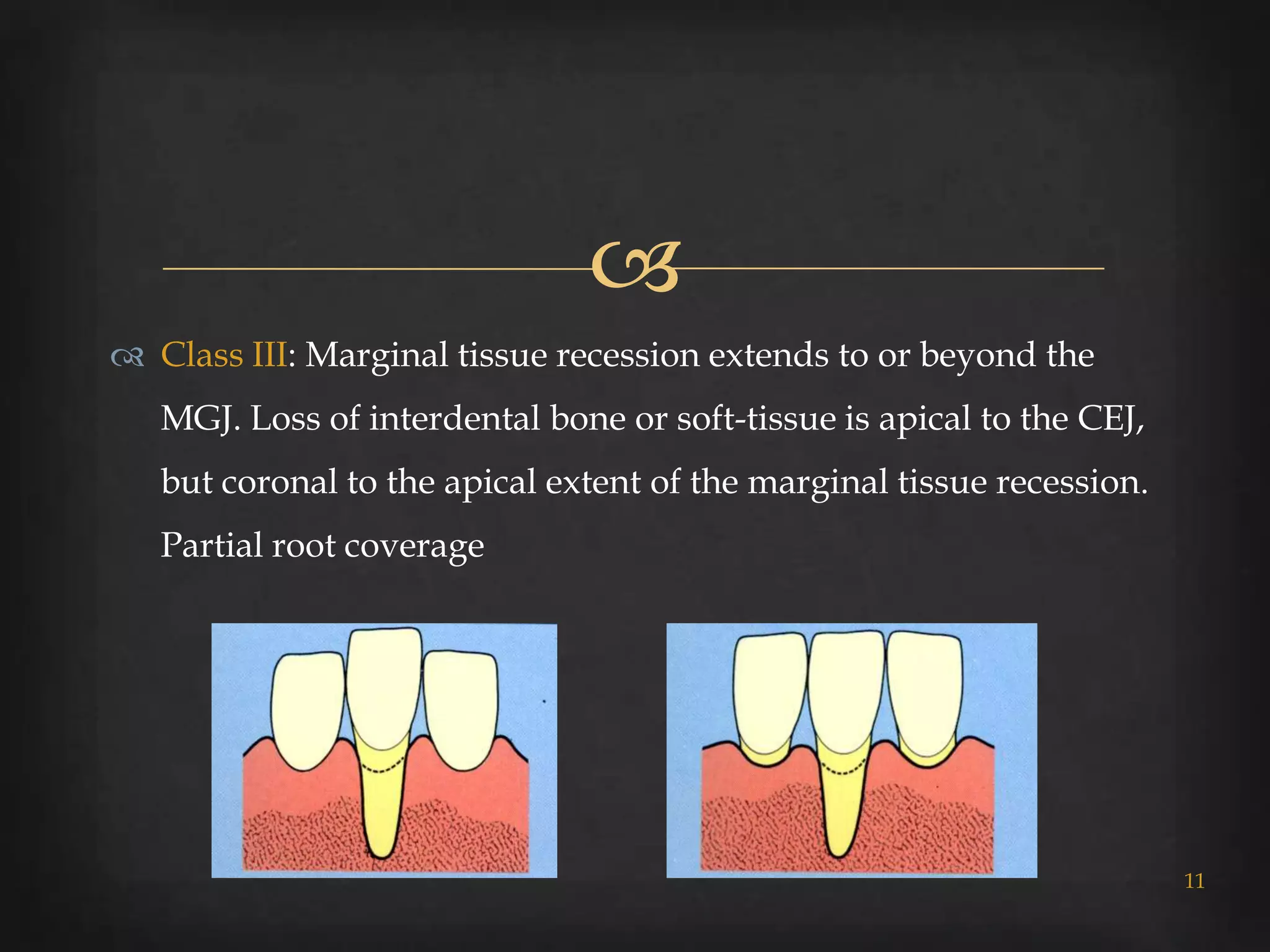 Gingival recession classifications | PPTX