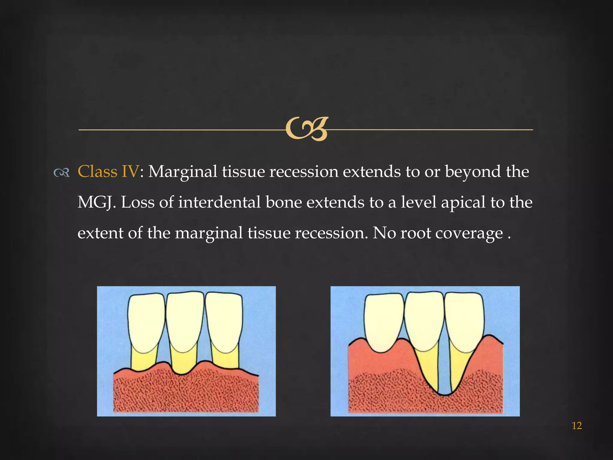 Gingival recession classifications | PPTX
