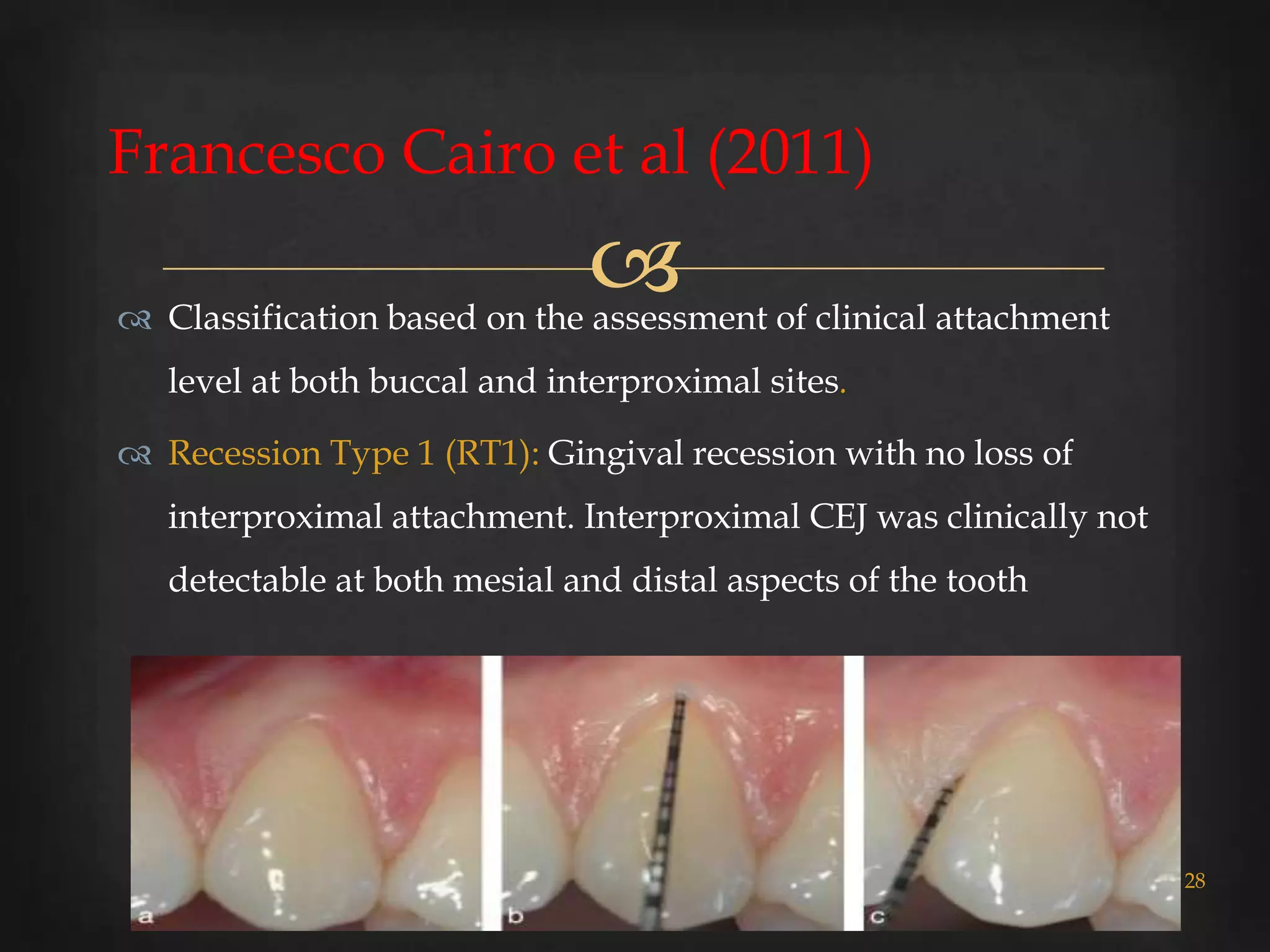 Gingival recession classifications | PPTX