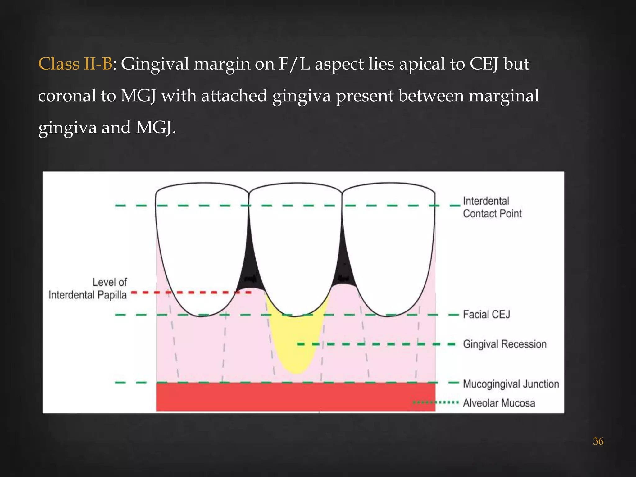 Gingival recession classifications | PPTX | Dental Health | Diseases ...