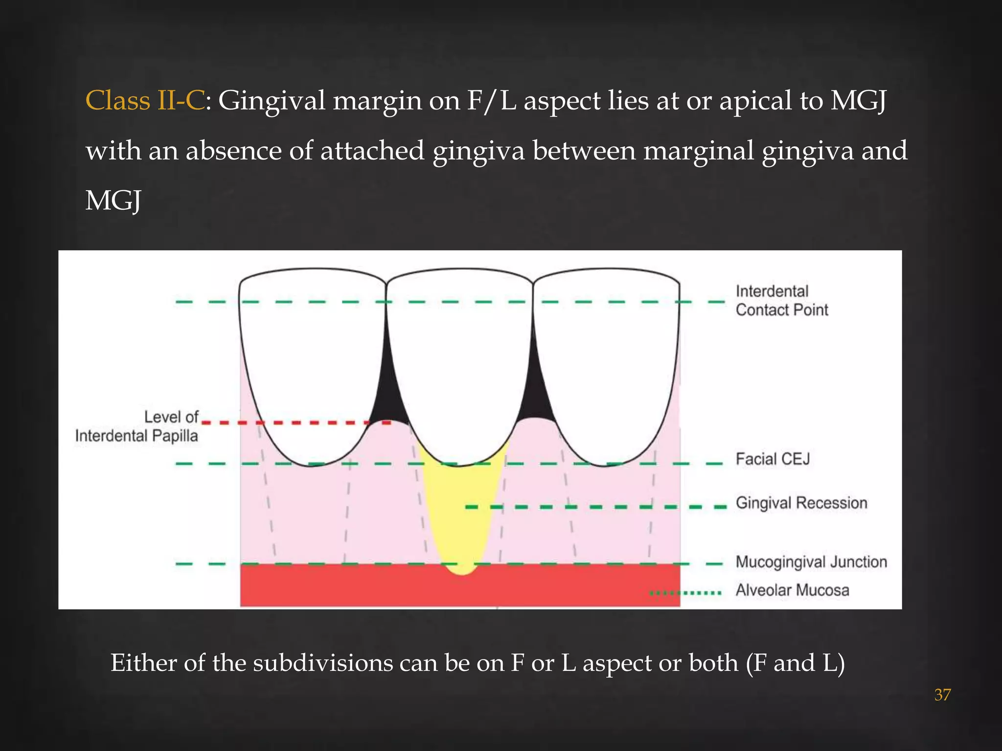 Gingival recession classifications | PPTX | Dental Health | Diseases ...