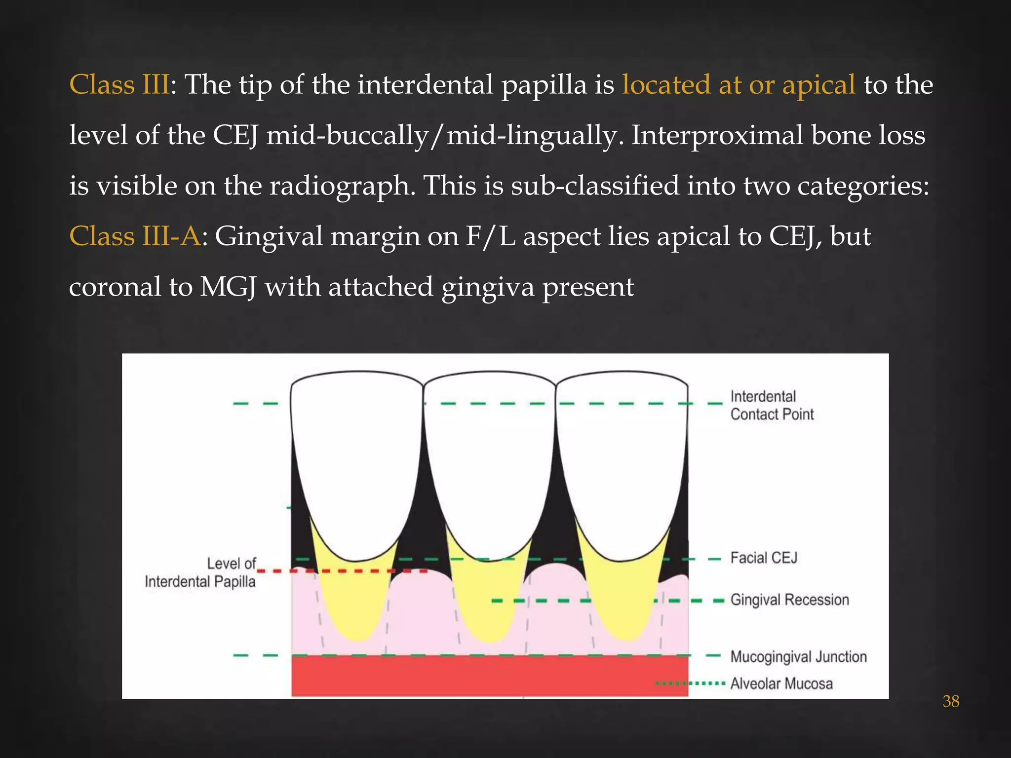 Gingival recession classifications | PPTX