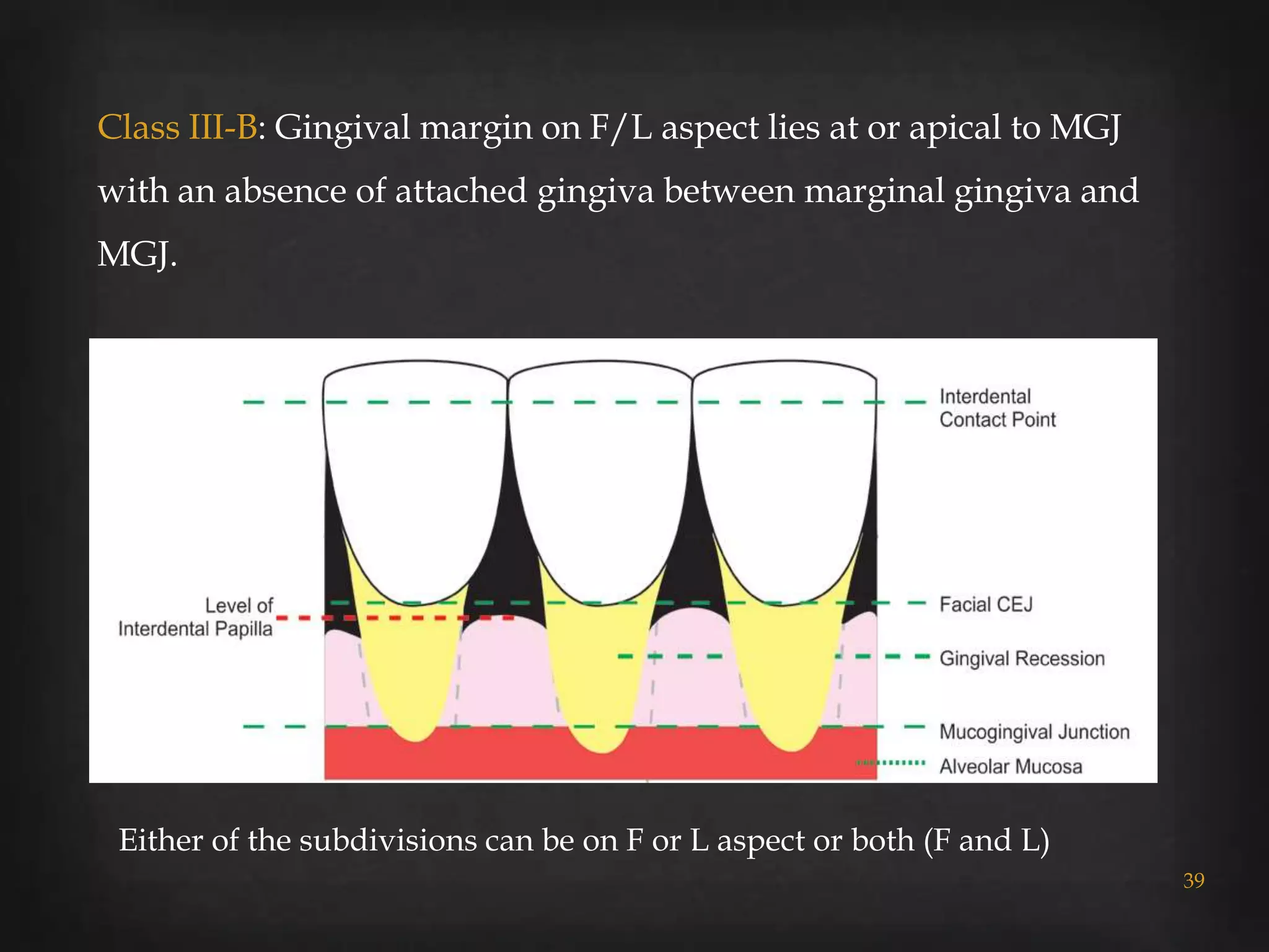 Gingival recession classifications | PPTX