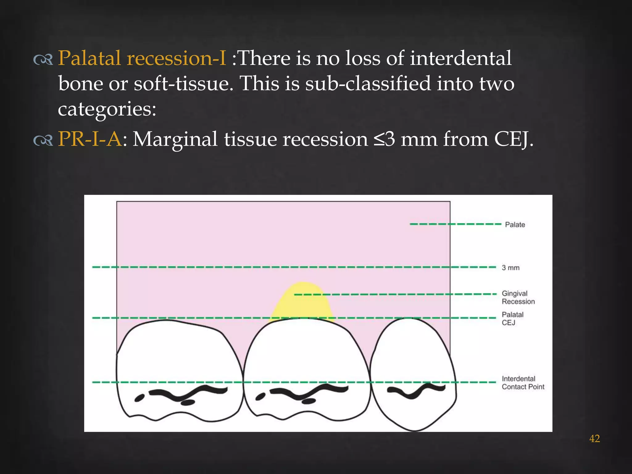 Gingival recession classifications | PPTX