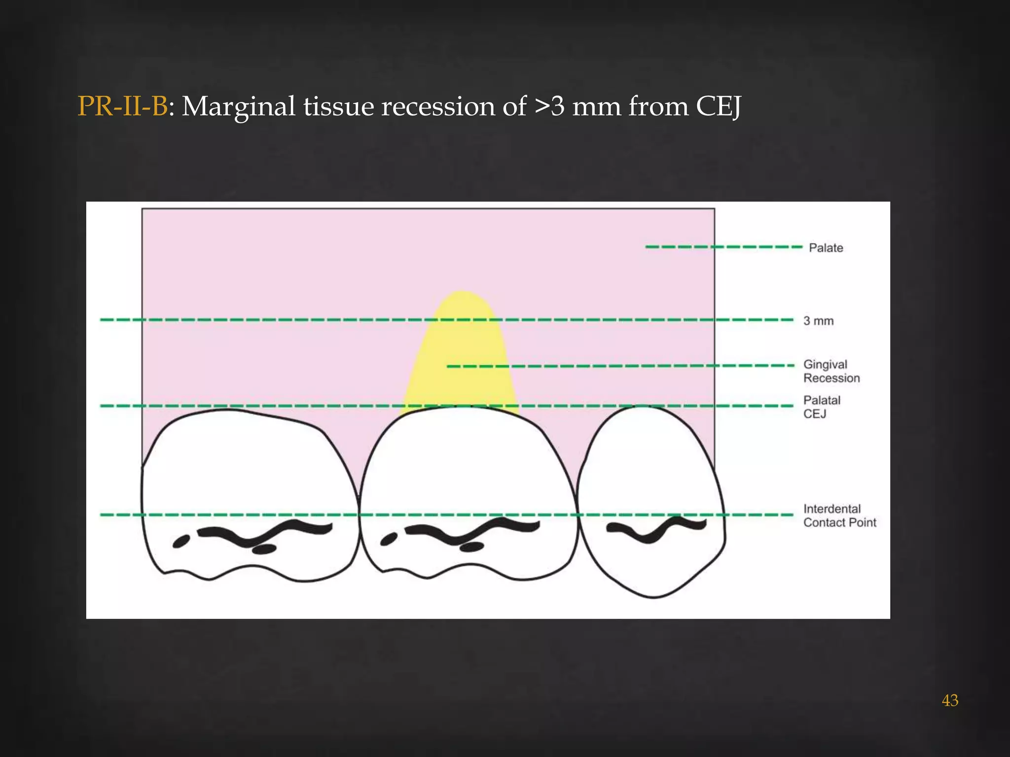 Gingival recession classifications | PPTX