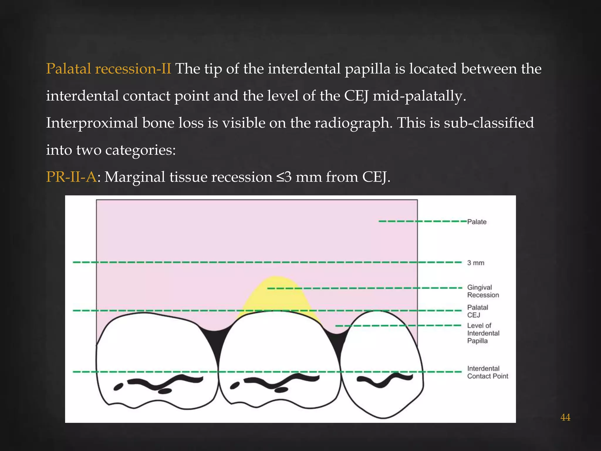 Gingival recession classifications | PPTX | Dental Health | Diseases ...