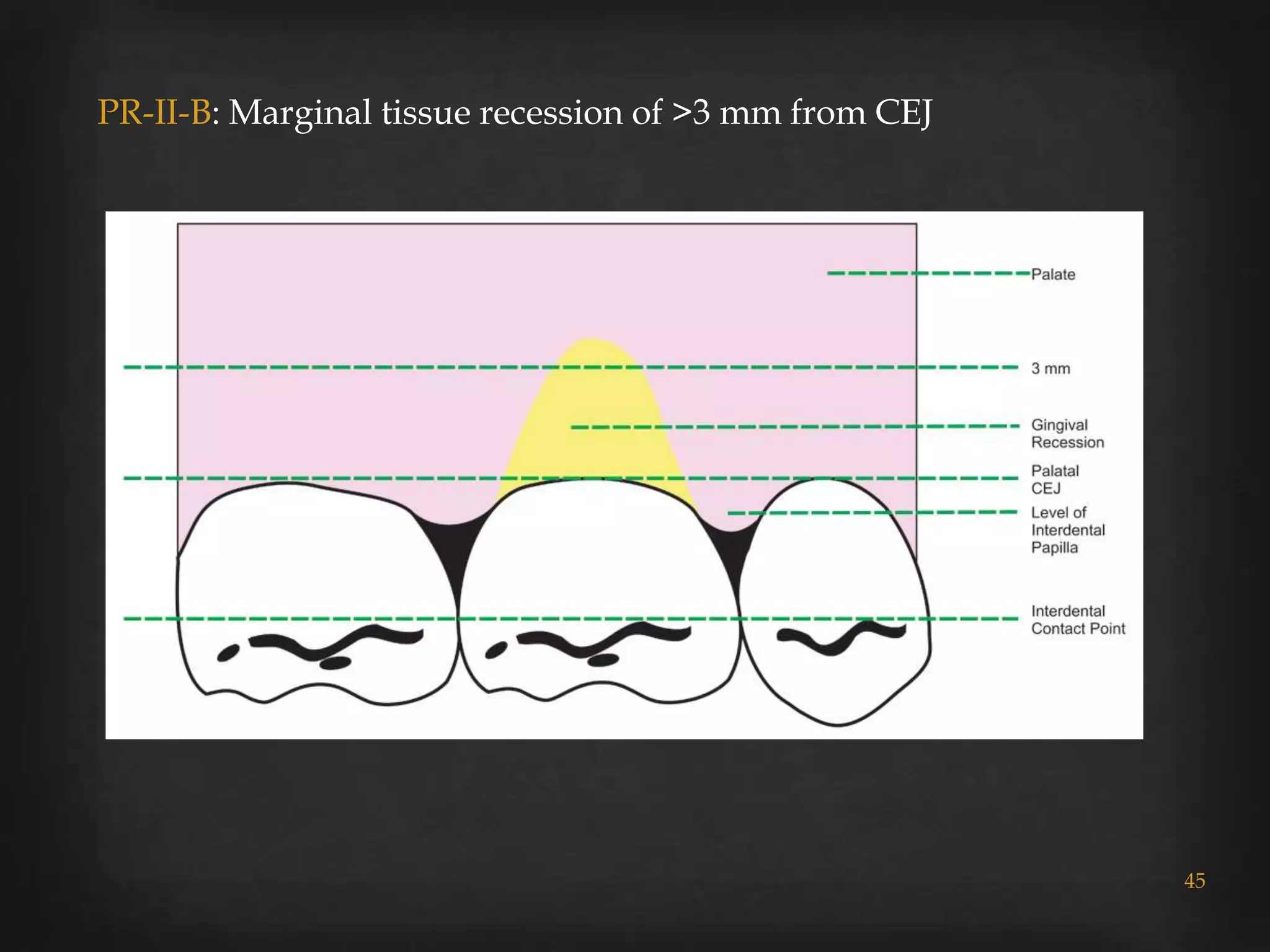 Gingival recession classifications | PPTX | Dental Health | Diseases ...
