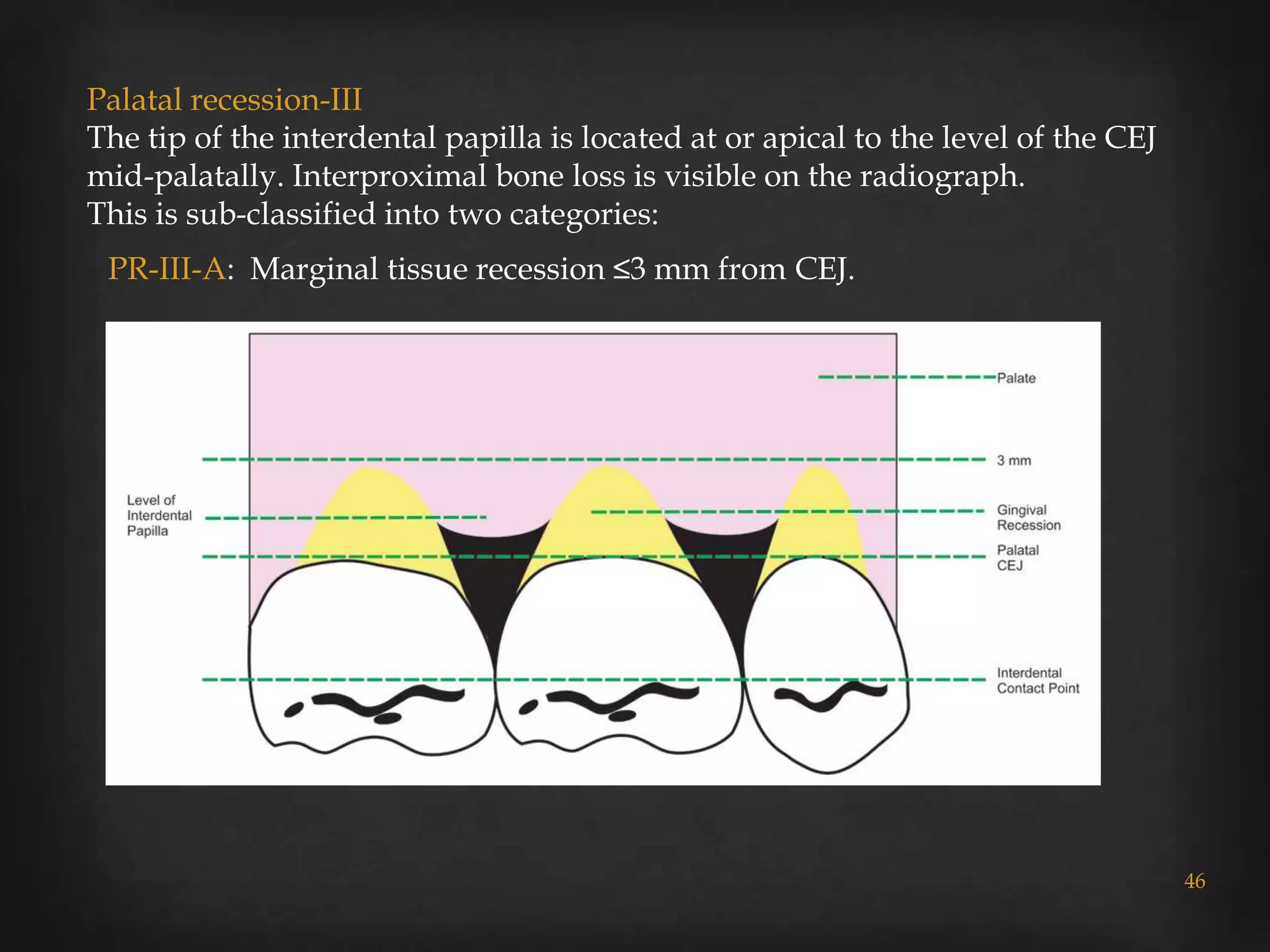 Gingival recession classifications | PPTX | Dental Health | Diseases ...