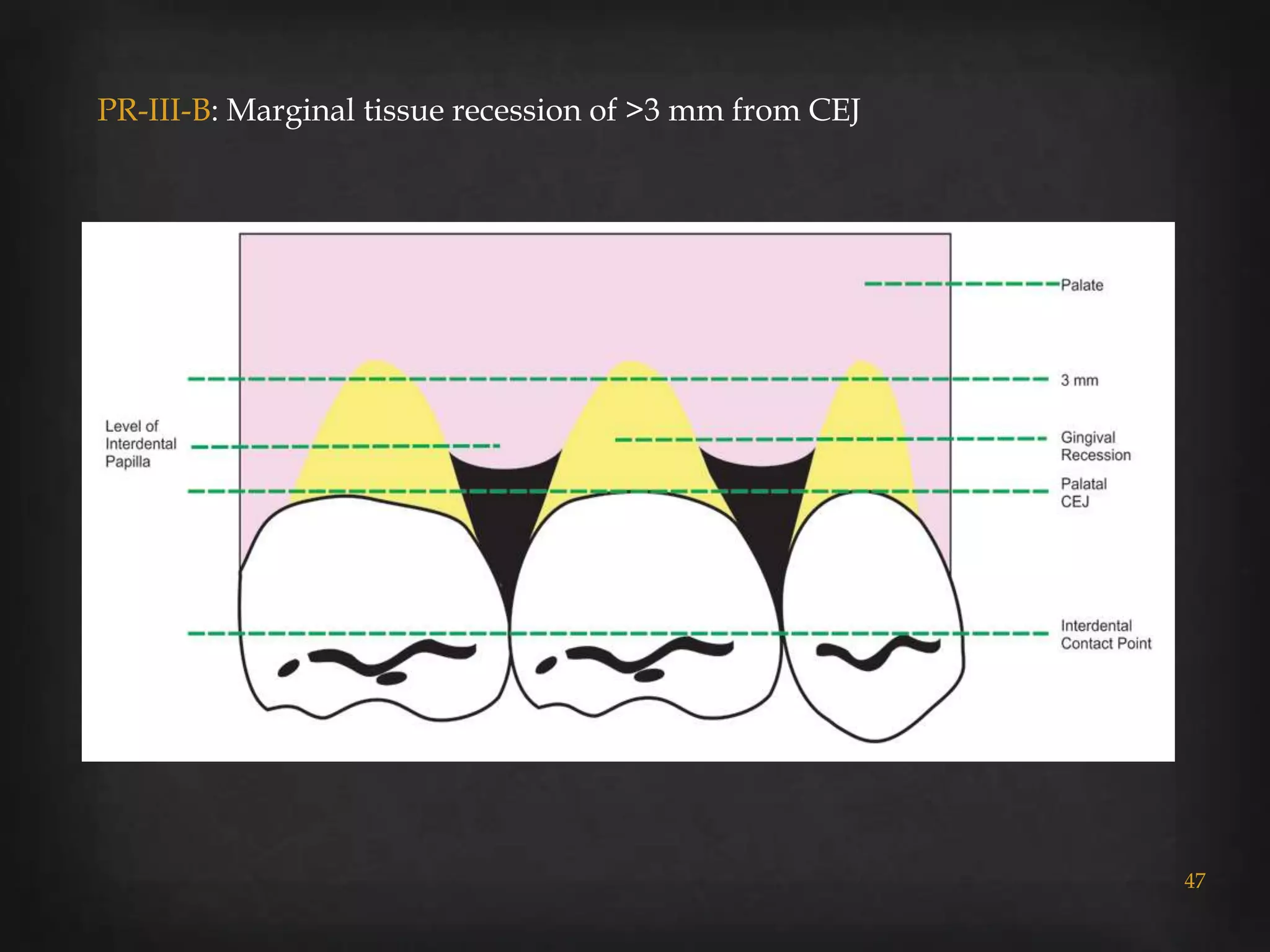Gingival recession classifications | PPTX | Dental Health | Diseases ...
