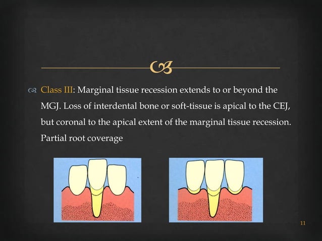 Gingival recession classifications | PPTX | Dental Health | Diseases ...