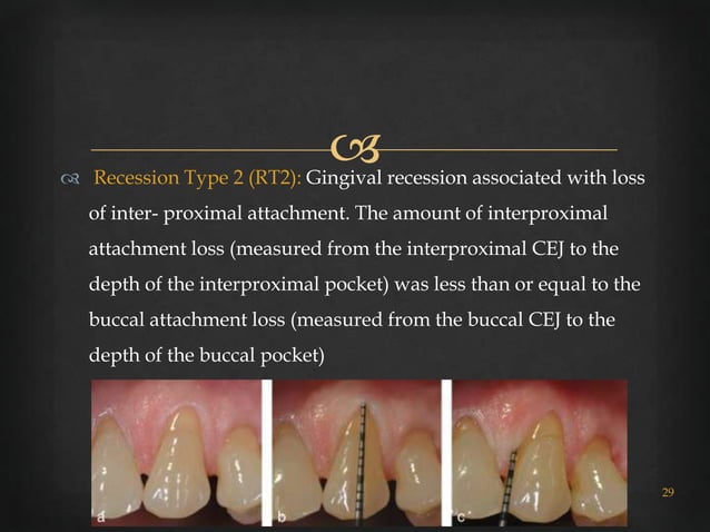 Gingival recession classifications | PPTX | Dental Health | Diseases ...