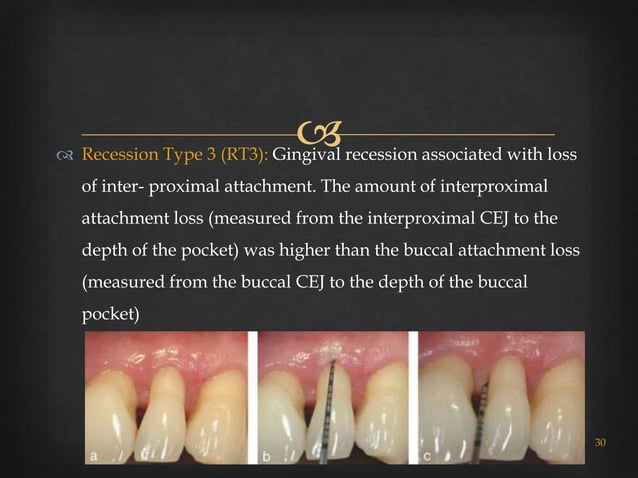 Gingival recession classifications | PPTX | Dental Health | Diseases ...
