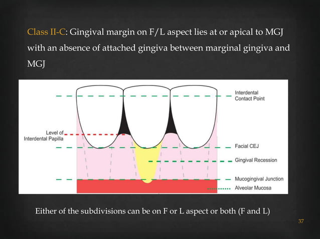 Gingival recession classifications | PPTX | Dental Health | Diseases ...