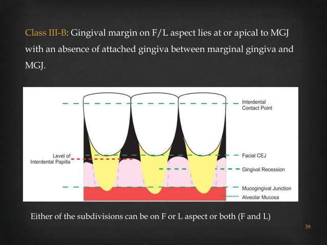 Gingival recession classifications | PPTX | Dental Health | Diseases ...