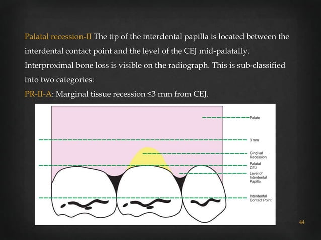 Gingival recession classifications | PPTX | Dental Health | Diseases ...