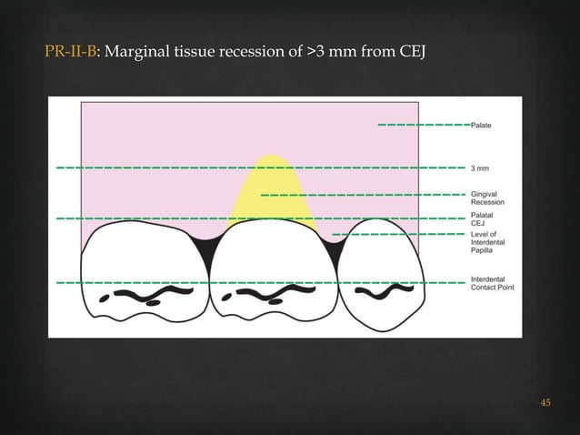 Gingival recession classifications | PPTX | Dental Health | Diseases ...