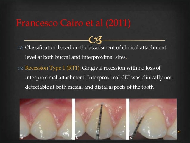 Gingival recession classifications