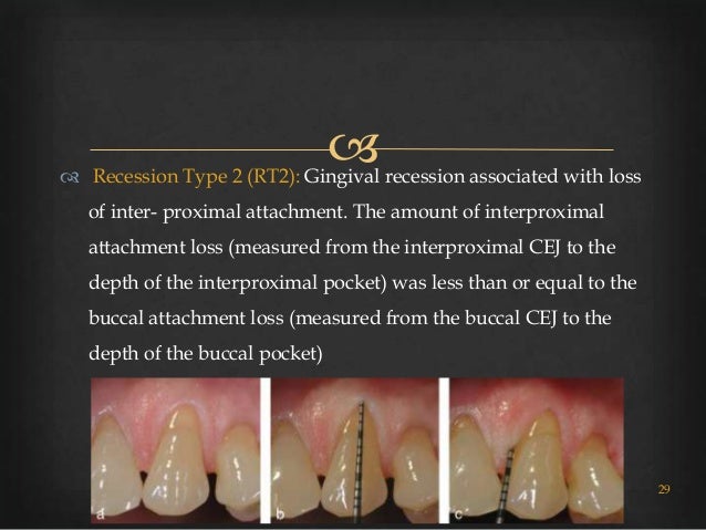 Gingival recession classifications