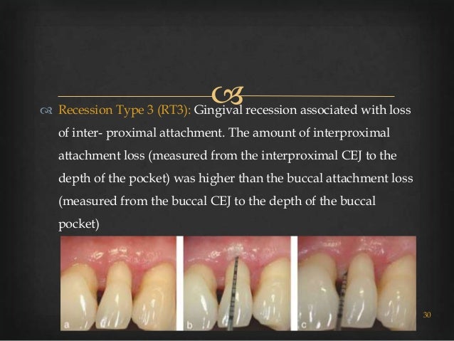 Gingival recession classifications