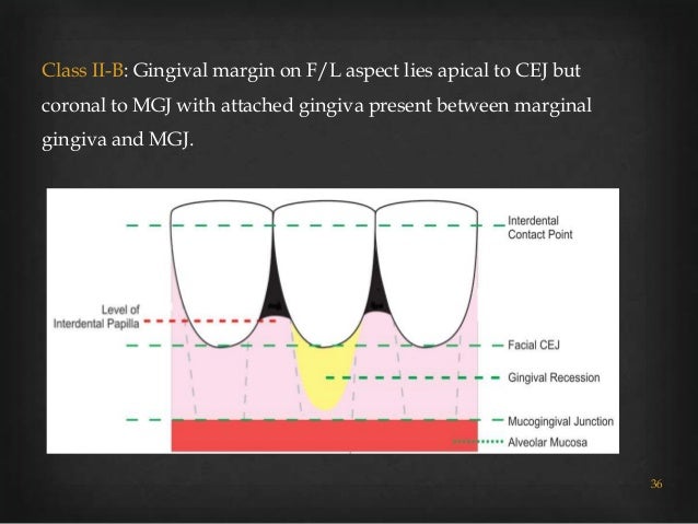 Gingival recession classifications