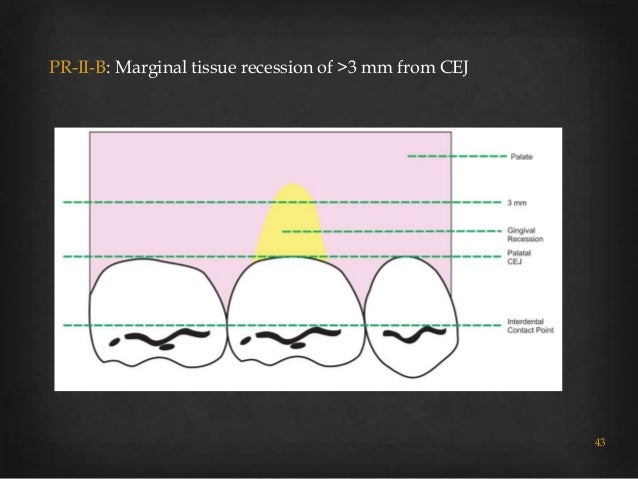 Gingival recession classifications